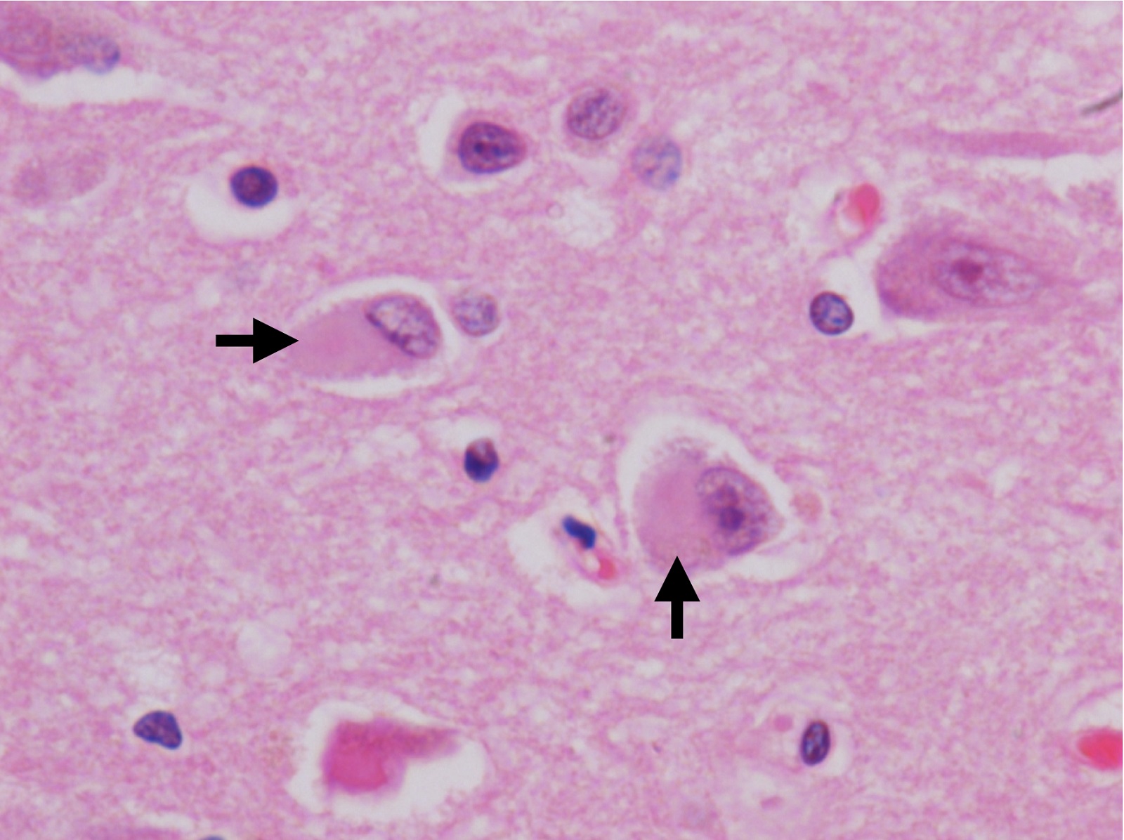 Research spotlight: Dementia with Lewy bodies | Alzheimer's Society
