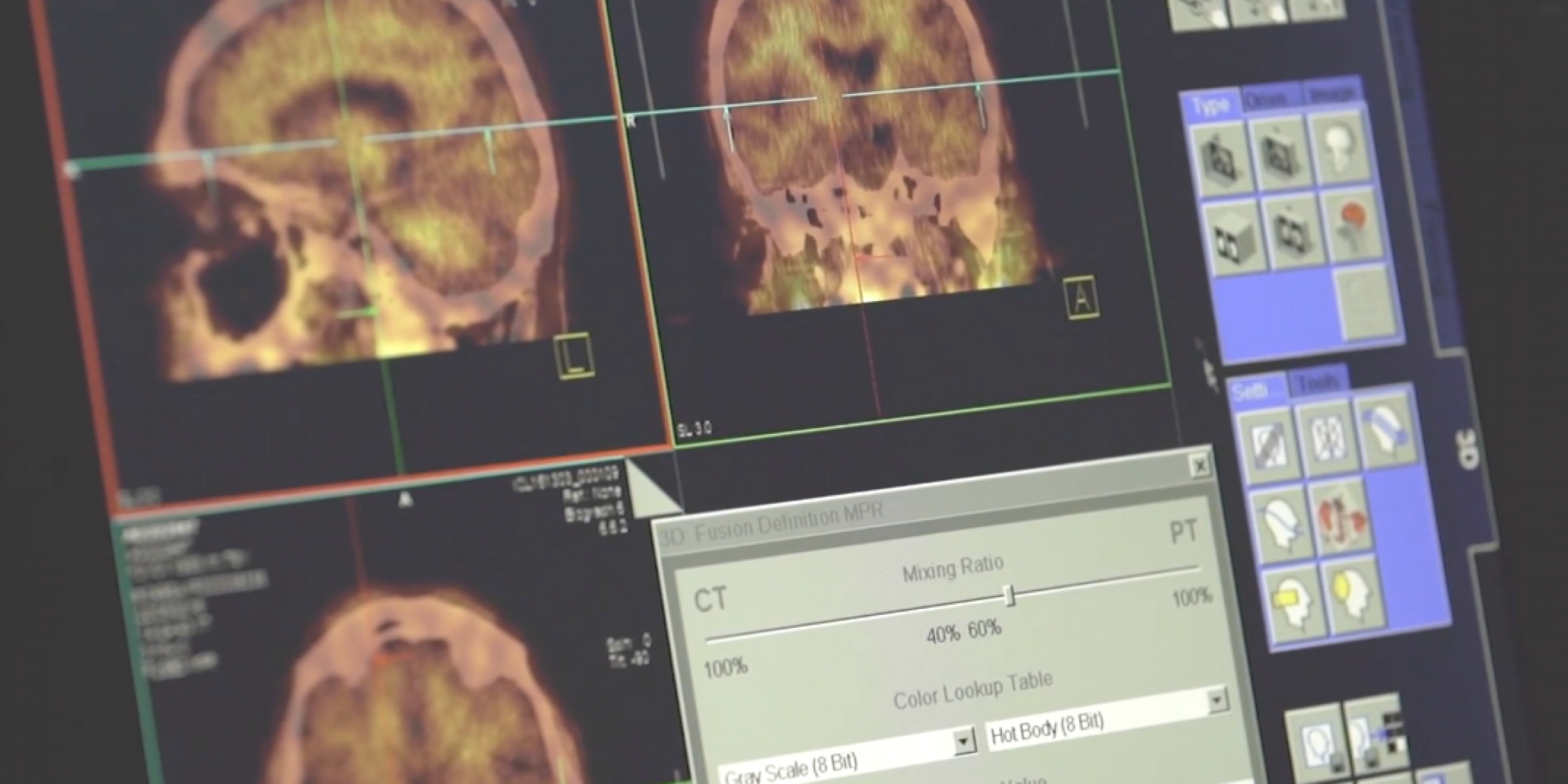 What can PET scans tell us about dementia? | Alzheimer's Society