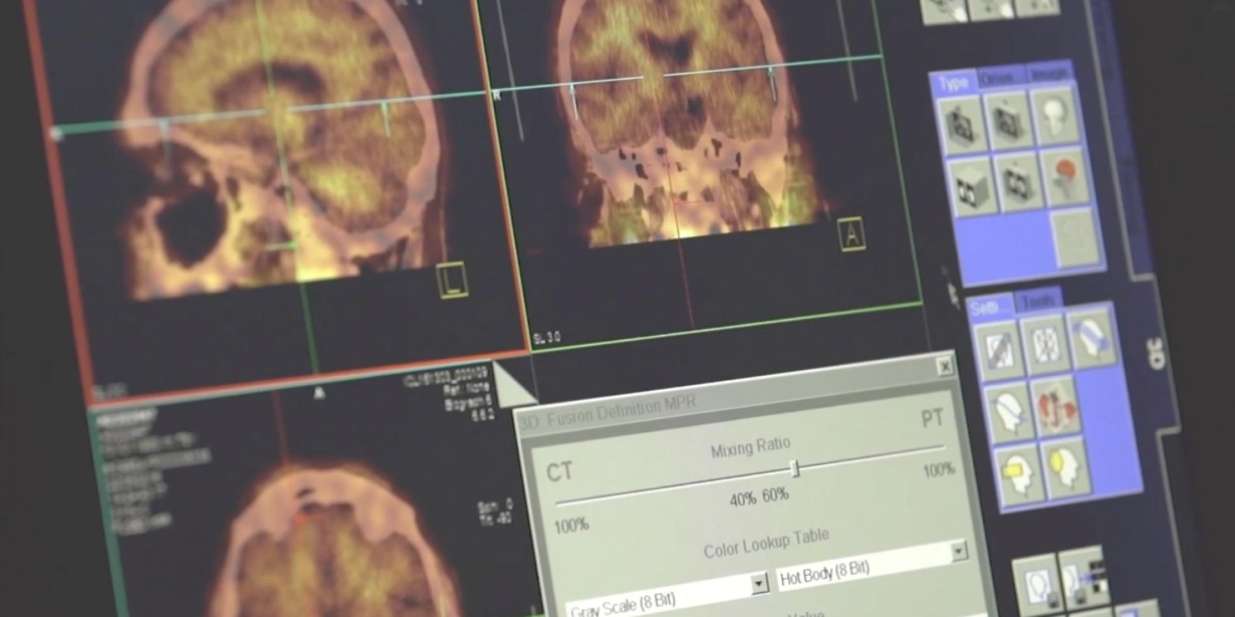 What can PET scans tell us about dementia? | Alzheimer's Society